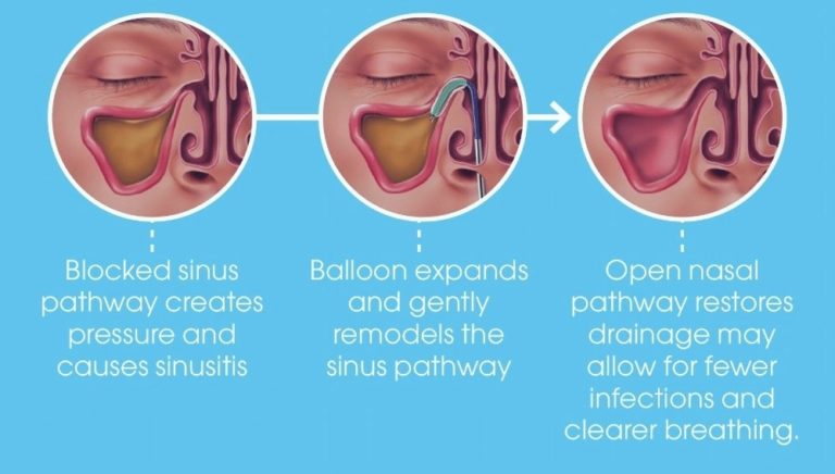 Balloon Sinus Dilation Boynton Beach FL - Balloon Sinuplasty FL