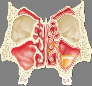 Propel Sinus Implant Boynton Beach FL - Sinus Surgery FL